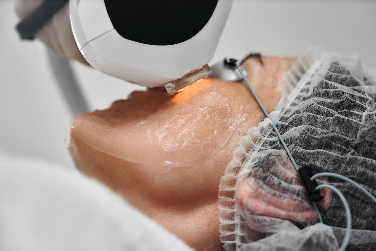 IPL Skin Rejuvenation - Richmond House Beauty